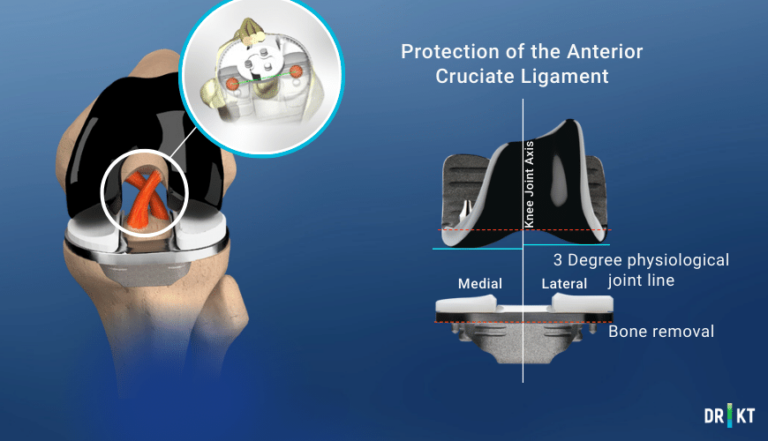 Best Knee Replacement Implant: Journey II XR Protecting the Cruciate ...