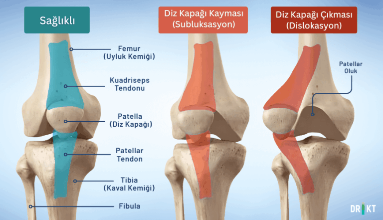 Diz Kapağı Kayması ve Diz Kapağı Çıkması: Belirtileri ve Tedavisi ...