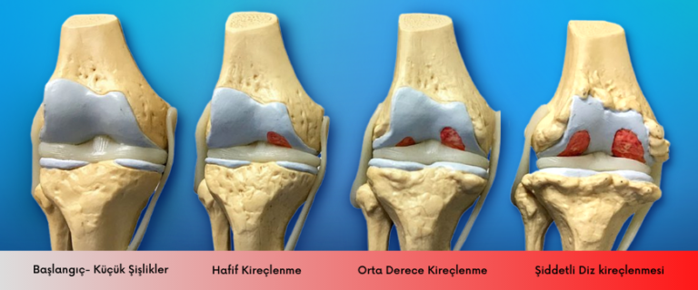 Diz İğnesi: Ameliyatsız Diz Sıvı Kaybı Tedavisi | Kayhan Turan ...