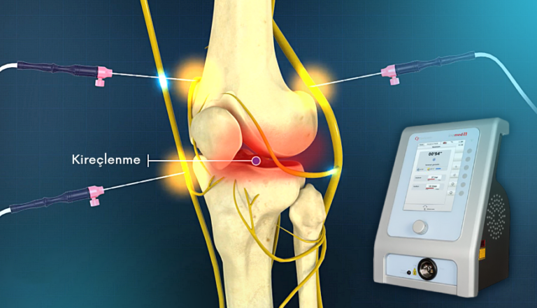 Diz İğnesi: Ameliyatsız Diz Sıvı Kaybı Tedavisi | Kayhan Turan ...
