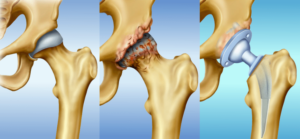 Kalça Kırığı Neden Olur? Belirtileri ve Tedavisi | Kayhan Turan ...