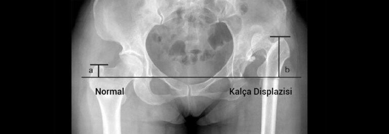 Kalça Ağrıları | Kayhan Turan | Robotik Ortopedi Cerrahi Derneği Başkanı