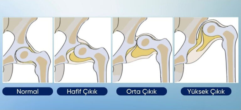 Yetişkinlerde Kalça Çıkığı, Belirtileri ve Tedavisi | Kayhan Turan ...