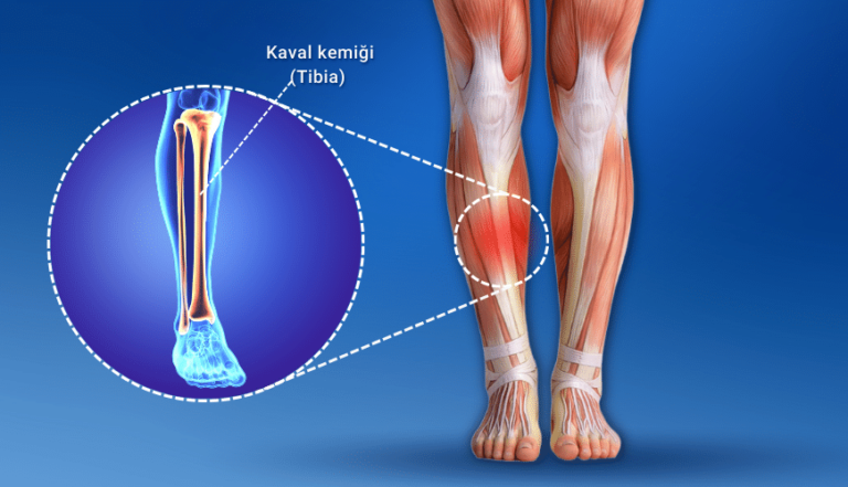 Bacak Ağrısı Nedir? Neden Olur ve Neyin Belirtisi ? | Kayhan Turan ...
